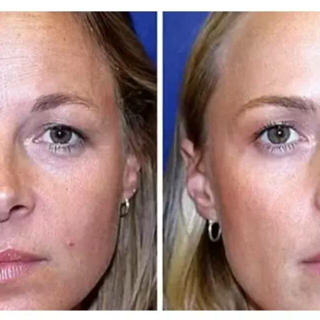 Botox na Testa - Para Que Serve, Riscos, Cuidados e Dicas