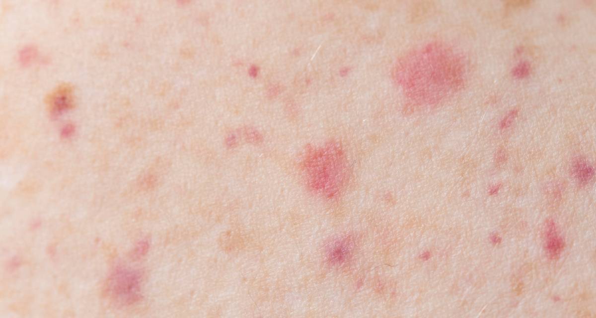 Pintas vermelhas - Entenda as causas e como tratá-las - MundoBoaForma
