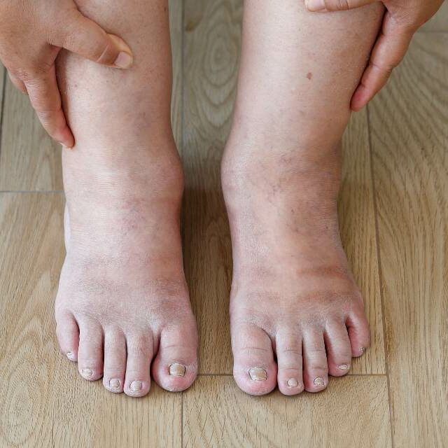 Tornozelos inchados: 11 principais causas e o que fazer - MundoBoaForma