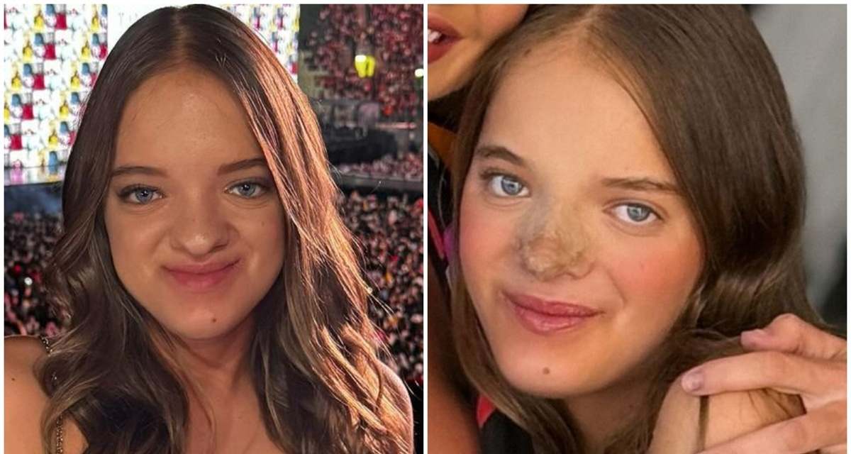 Rinoplastia de Rafa Justus levanta polêmica: afinal, pode fazer ...