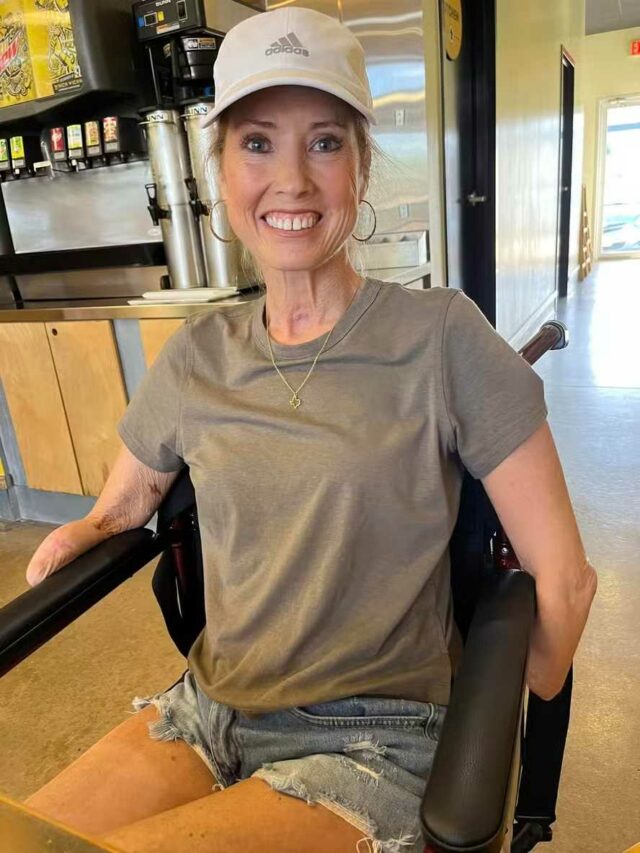 Dor de garganta leva à sepse e professora tem pés e mãos amputadas ...