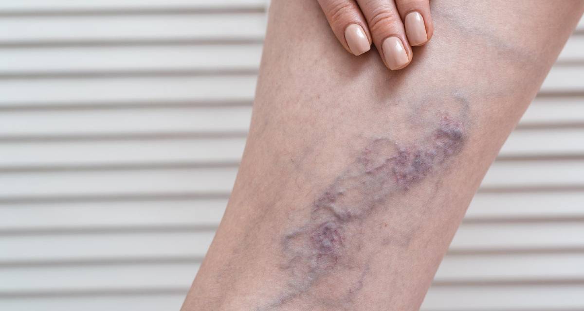 Manchas roxas nas pernas pode ser leucemia? - MundoBoaForma