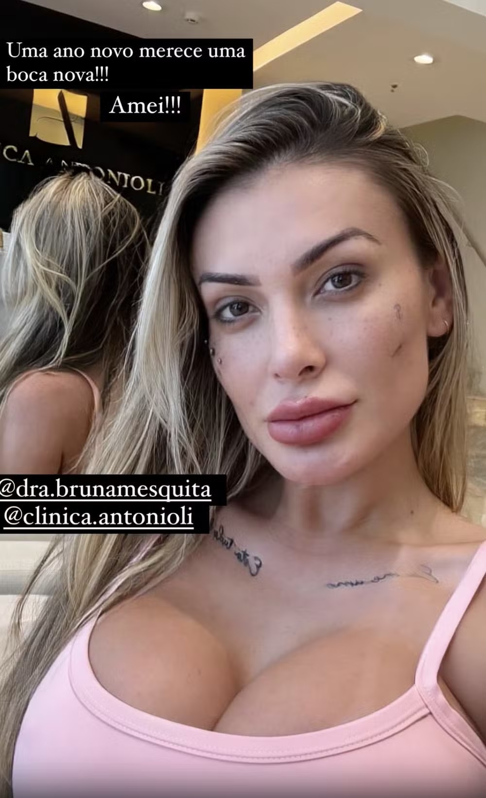 Andressa Urach faz novo preenchimento na boca após gastar mais de R$ 500 mil em procedimentos ...