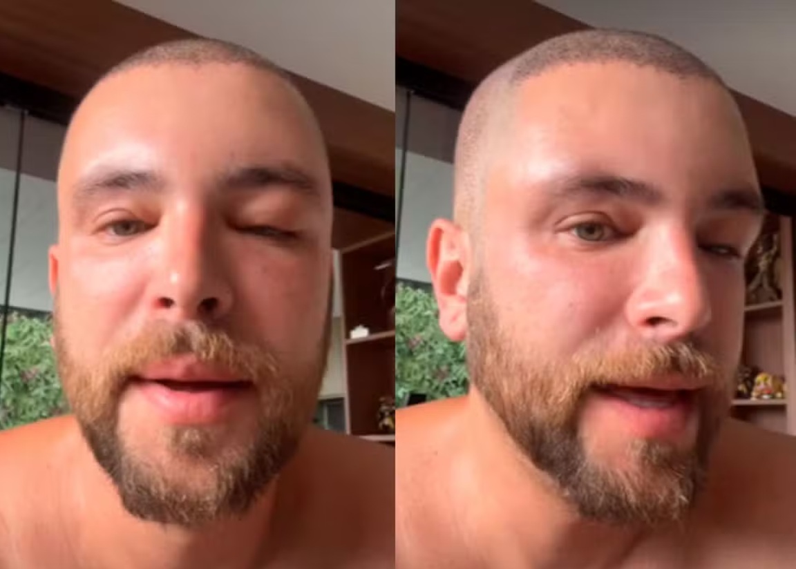 Ex-"BBB" Gustavo Marsengo mostra inchaço no rosto após transplante ...